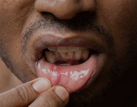 White Spots On Gums Causes Treatment And Prevention Natrusmile