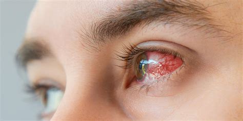 Infecciones Oculares Más Comunes Conjuntivitis Orzuelos Infección