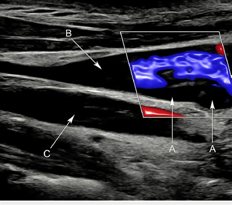 Longitudinal Sonogram Of The Left Neck Sonogram Demonstrates A