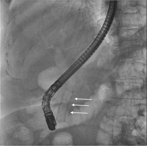 Endoscopic Balloon Dissection To Remove A Percutaneously Placed Biliary Stent With Tissue