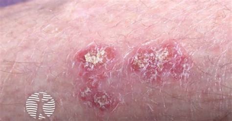 Chronic Plaque Psoriasis Image