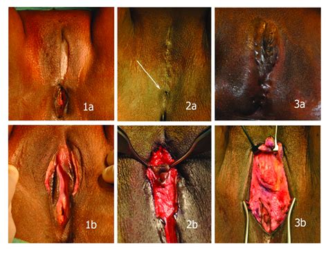 In Spite Of Considerable Differences In The Extent Of The Mutilations