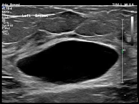 Atlas Of Breast Cancer Early Detection