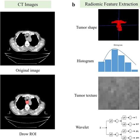Radiomic Feature Extraction A The Regions Of Interest Roi Of Tumors
