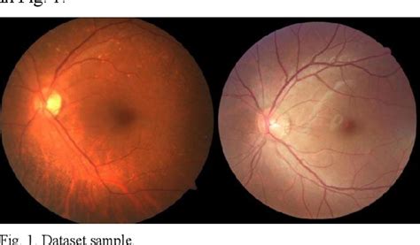 Figure 1 From Glaucoma Diagnosis And Prediction Based On Multi Scale Feature Coding Semantic