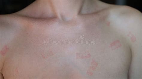 Red Itchy Patch Rash On Woman Skin Closeup Stock Image Image Of Itchy