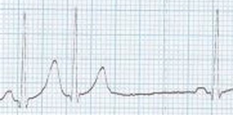 Supraventricular Ectopics All About Cardiovascular System And Disorders