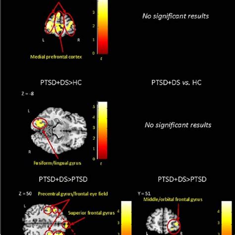 Fig Ure 2 Between Group Resting State Functional Connectivity Results Download Scientific