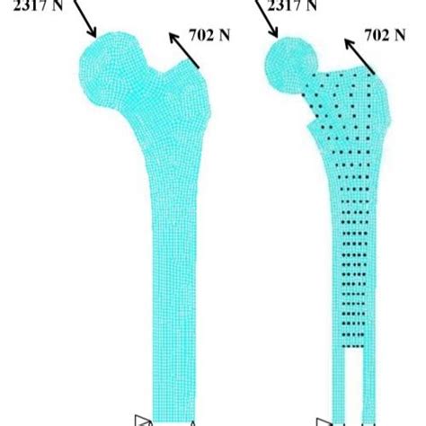2d finite element models of the femur left and the prosthesis