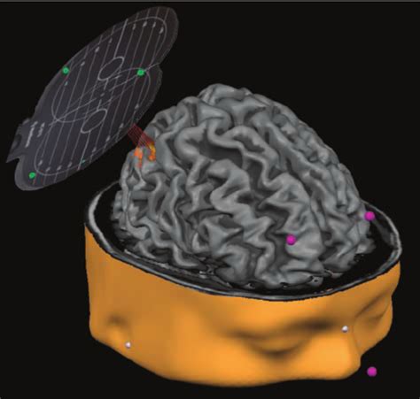 Tms Neuronavigation Based On Individual Fmri Data An Example Of Tms Neuronavigation Based On Individual Fmri Data An Example Of
