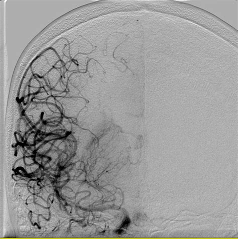 Reperfusion Scale Tici Stroke Endovascular