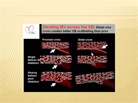 Strategies Of Handling Side Branch During Pci Pptx Heart And