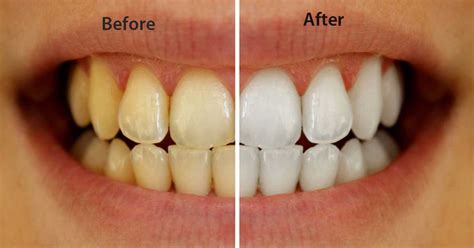 7 Incredible Ways To Whiten Your Teeth Naturally