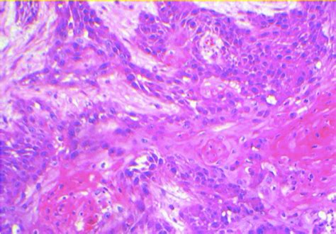 Figure 2 From A Rare Case Of Penile Epidermoid Carcinoma Semantic Scholar