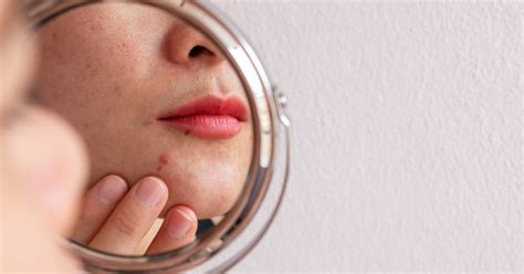 Patch Anti Bouton Est Ce Efficace