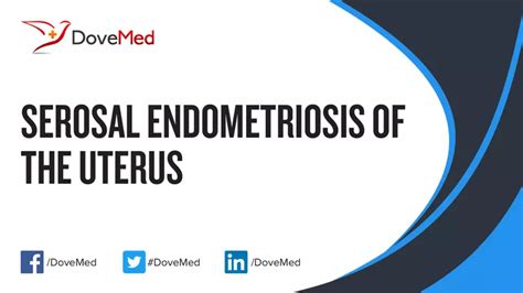 Serosal Endometriosis Of The Uterus Dovemed