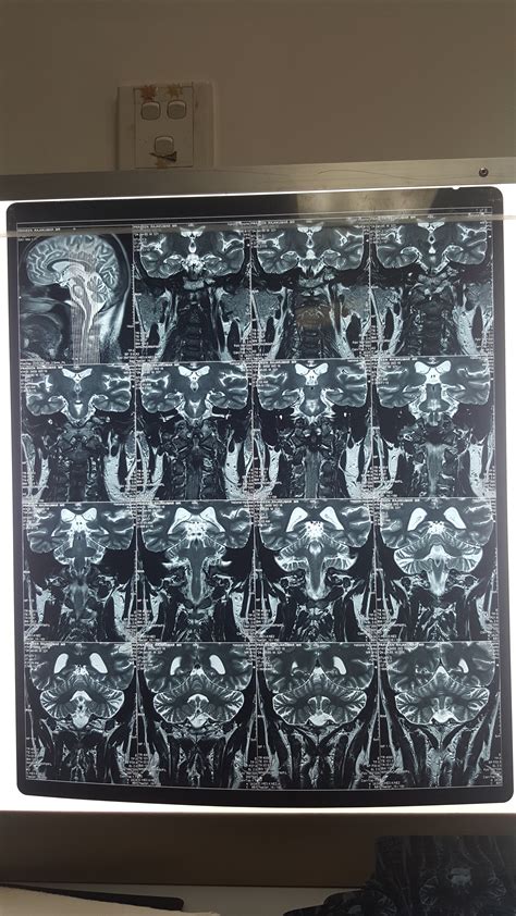 Can This Be Osmotic Demyelination Is The Mri Compatible