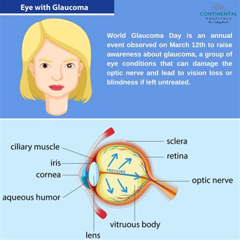 World Glaucoma Day March 12th 2024
