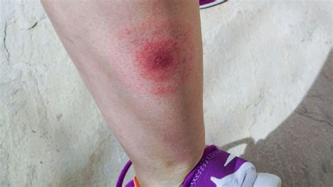 Hardlopennl Wat Doe Je Bij Een Tekenbeet