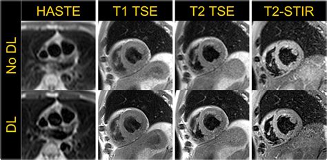Half Fourier Acquisition Single Shot Turbo Spin Echo Haste In An Download Scientific Diagram