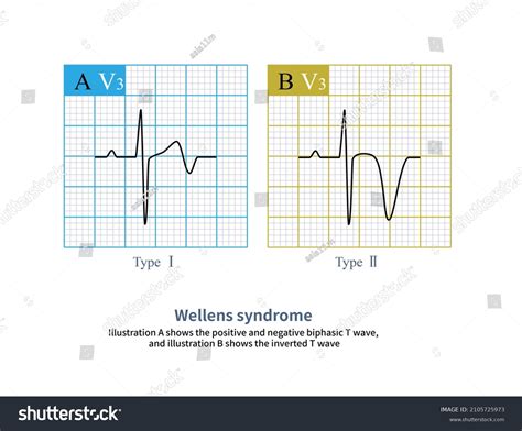 웰렌스증후군의 Ecg 변화는 근위 왼쪽 앞에 스톡 일러스트 2105725973 Shutterstock