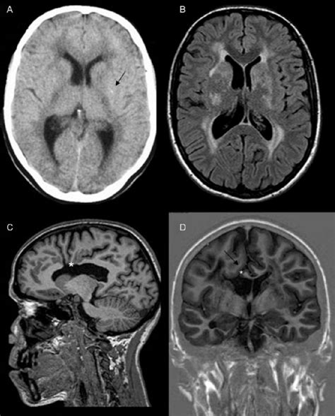 Ct And Mri Of Patient 1 A Axial Ct Brain Image Showing A Punctate