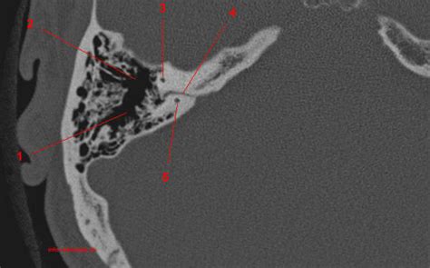 CT Scan Of The Temporal Bone W Radiology