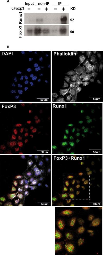 Runx1 And Foxp3 Interplay Regulates Expression Of Breast Cancer Related