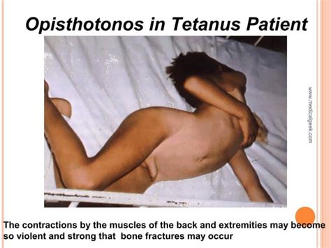 Tetanus Presentation PPT