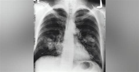 Cap And Other Societies Draft Guidelines For Pd L1 Testing Medical