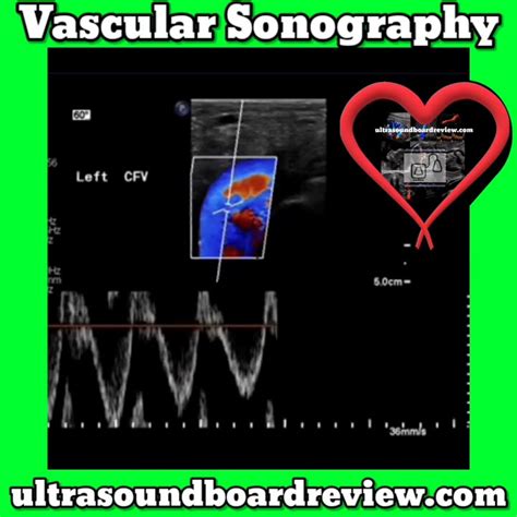 Pulsatile Venous Waveform Youtube