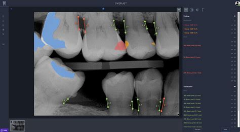 Accuracy Of Ai In Caries Detection