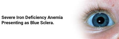 Severe Iron Deficiency Anemia Presenting As Blue Sclera