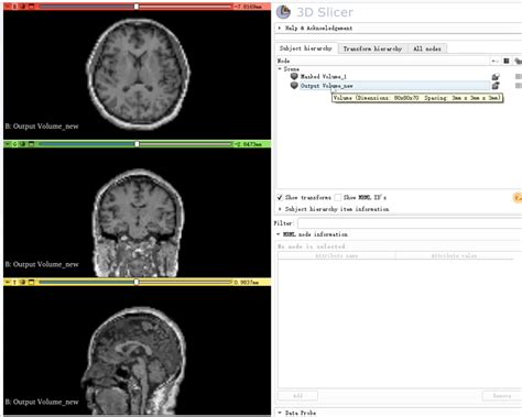 用3d slicer 对核磁结构影像做降维处理 3dslicer中的resample image brain 作用 csdn博客