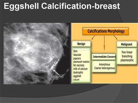 Egg Shell Calcification Breast Radiology Classroom