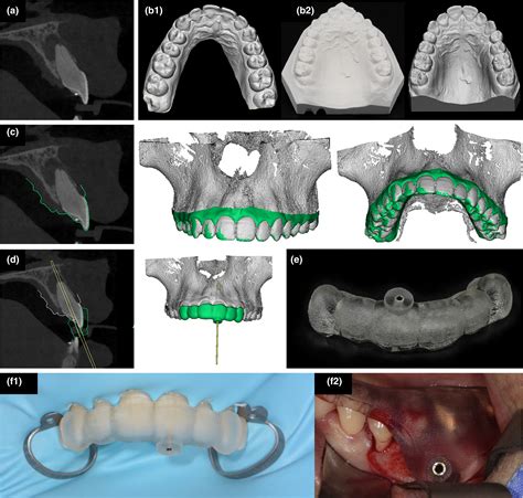 Guided Endodontics Review Article At Ebony Butters Blog