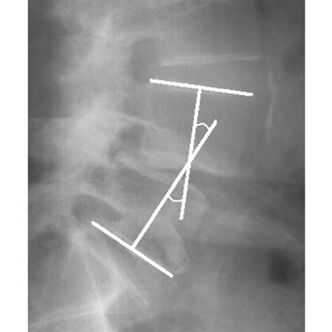 The Facet Joint Orientation In The Horizontal Plane Was Measured As The Download Scientific