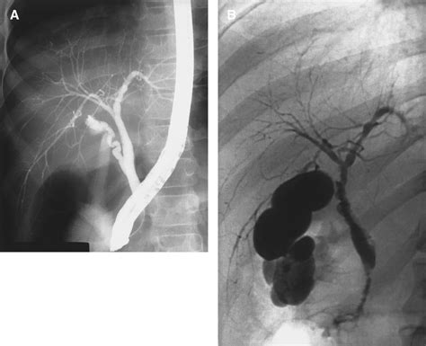 A Endoscopic Cholangiography Performed At Presentation In A Patient Download Scientific