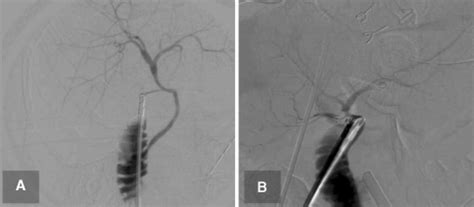 Documentation Of The Biliary Anatomy By Intraoperative Cholangiography