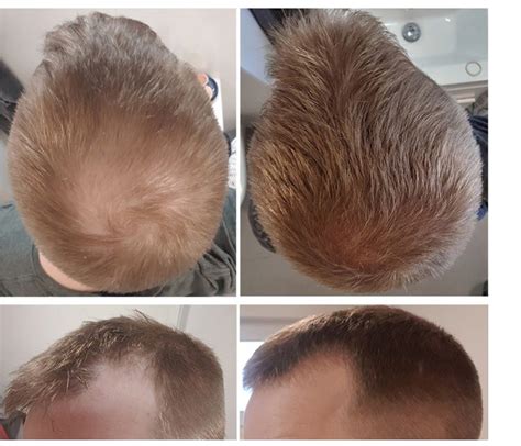 Does Finasteride Regrow Hair Expert Review