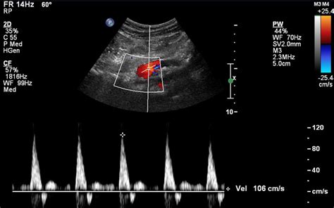 Lower Extremity Venous Duplex Ultrasound Chronic Venous 47 Off