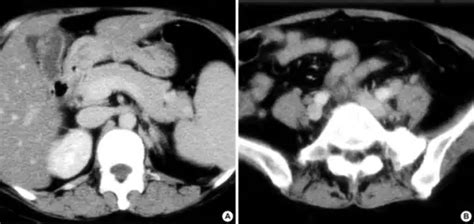 Multiple Organ Dysfunction Pathosomes