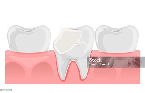 부러진 치아 플랫 스타일로 금이 간 치아 치아와 잇몸 해부학 치아 건강 흰색으로 분리된 벡터 그림입니다 개념에 대한 스톡 벡터 아트 및 기타 이미지 Istock