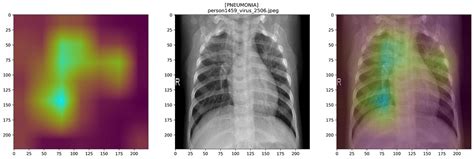 Pneumonia Detection Using Convolutional Neural Network By Chi Bui Medium