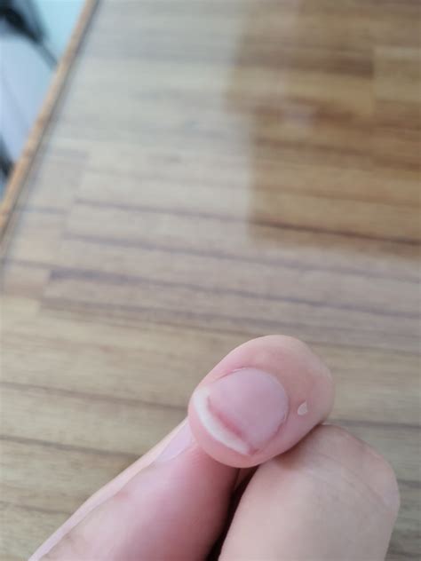 손톱 밑 피 지식in