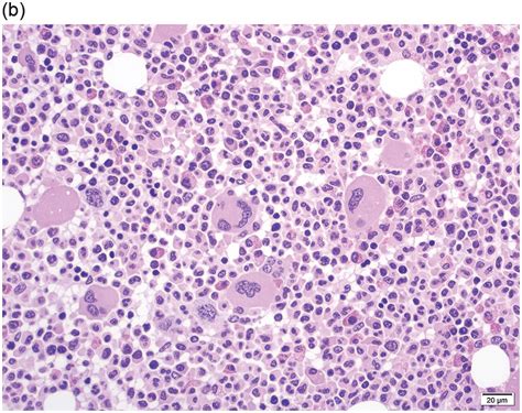 Chapter 13 Myeloid And Lymphoid Neoplasms Associated With Eosinophilia Oncohema Key
