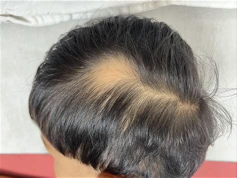 A Case Of Congenital Extratemporal Non Triangular Alopecia Of The Scalp