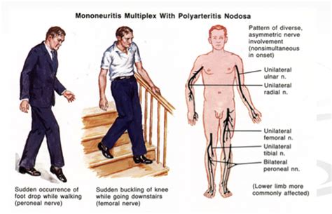 Mononeuritis Multiplex Flashcards Quizlet
