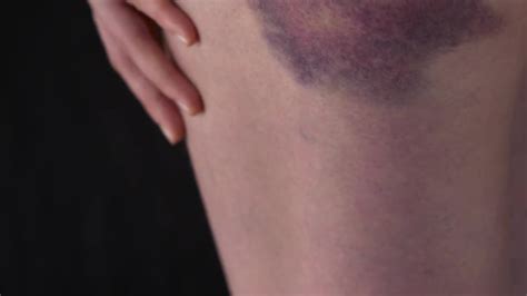 Hamstring Bruise Stock Video Motion Array