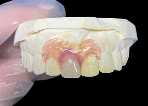 Nesbit Flexible Partial Denture For Incisors Offering A Seamless Removable Tooth Replacement